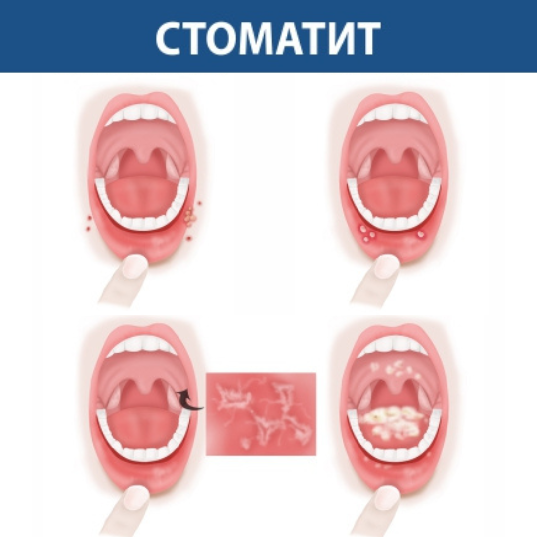 Амны хөндийн үрэвсэл буюу стоматит “ЦАХИУР ТӨМӨР” ХХК